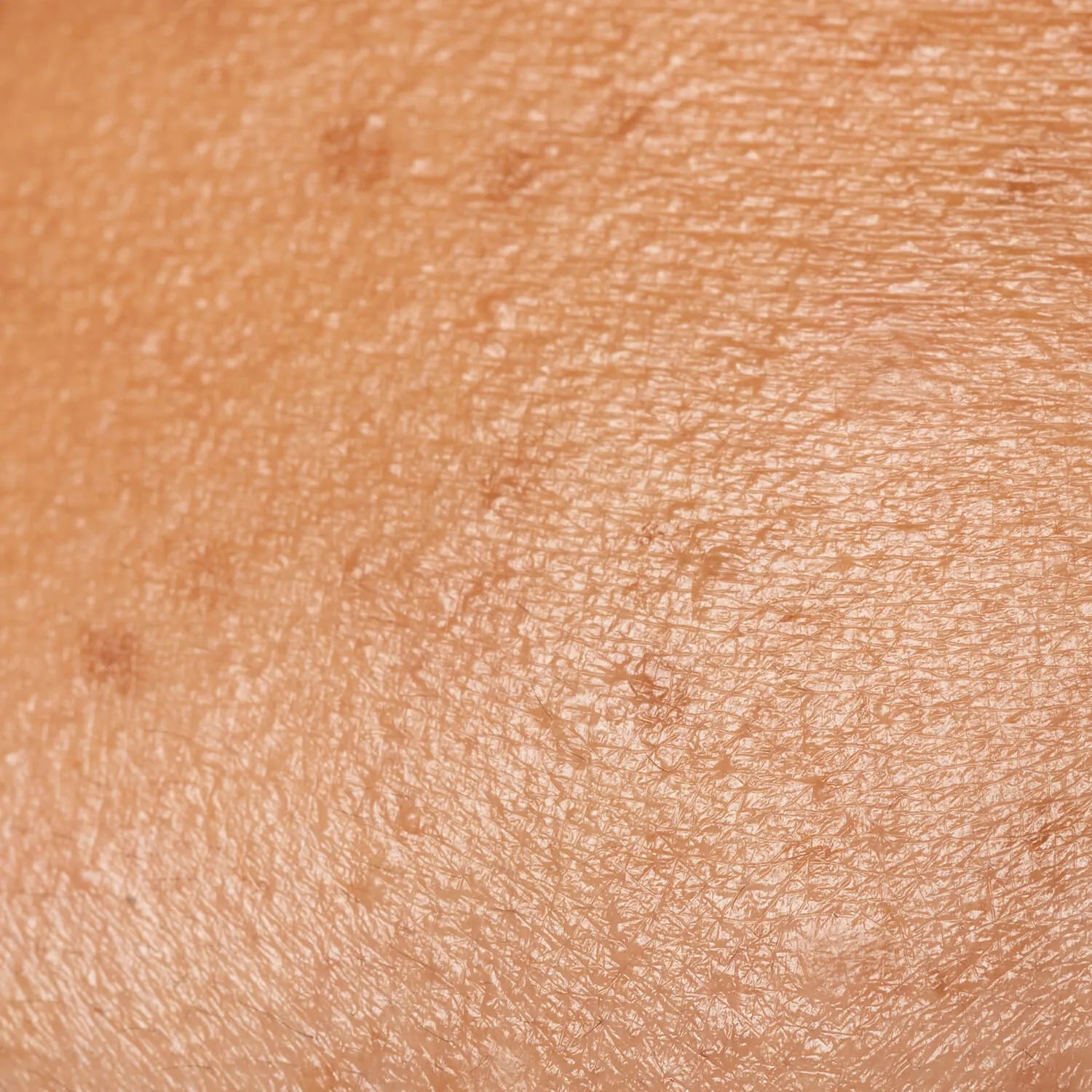 Treating and preventing pigment spots